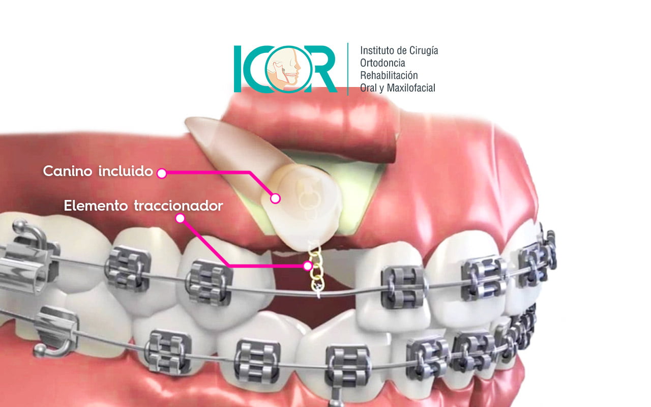 Desinclusión de caninos - Caninos incluidos en maxilar - icor 3 - ICOR