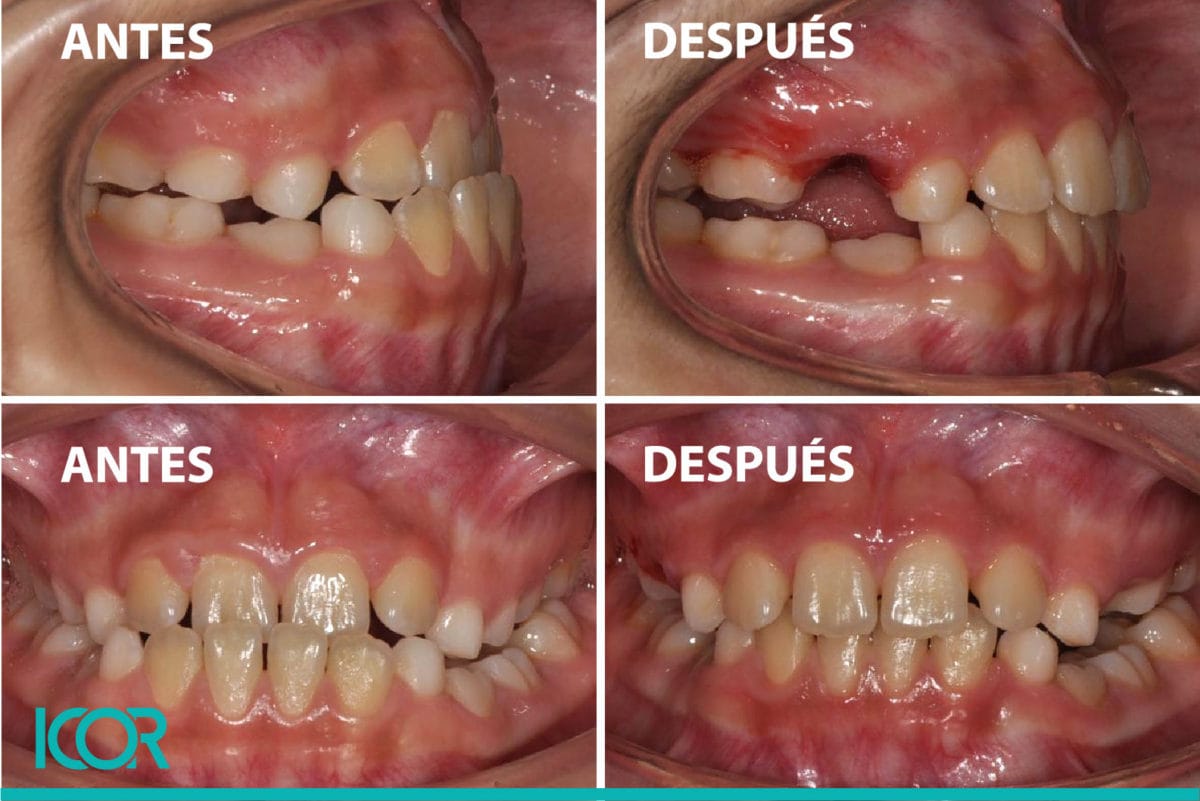 mordida invertida - icor-12 - ICOR