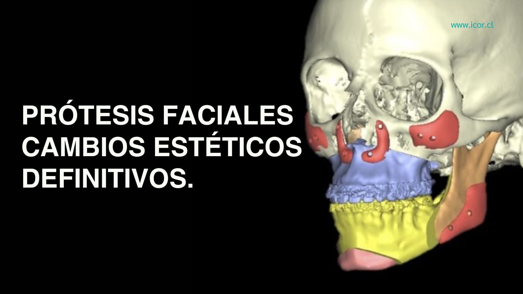 Prótesis faciales para cambios estéticos en cirugía